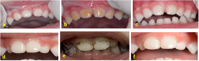 Journal of Clinical Pediatric Dentistry (JOCPD)