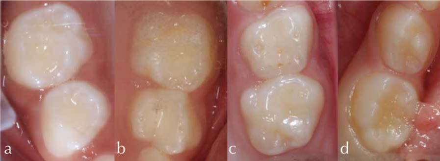 Journal of Clinical Pediatric Dentistry (JOCPD)