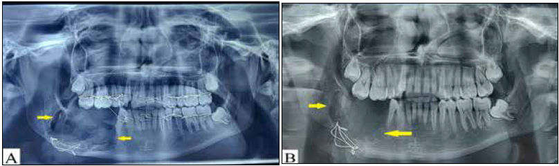 Journal of Clinical Pediatric Dentistry (JOCPD)