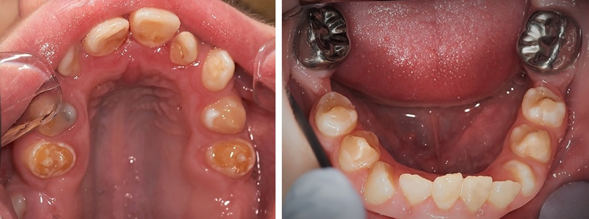 Journal of Clinical Pediatric Dentistry (JOCPD)