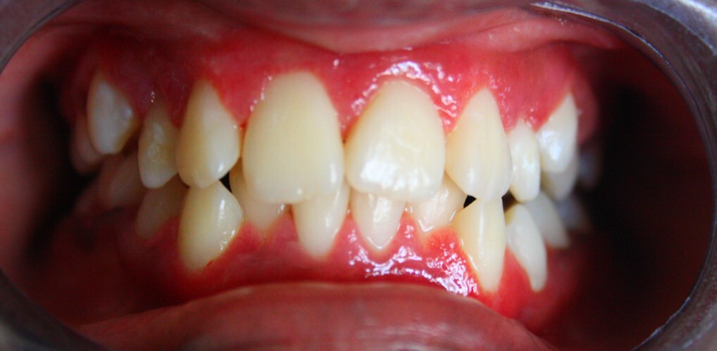 Journal of Clinical Pediatric Dentistry (JOCPD)