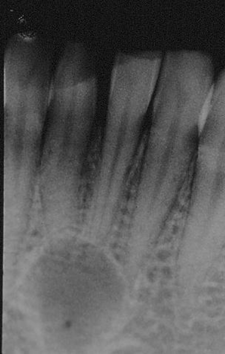 Rampant Caries Radiograph