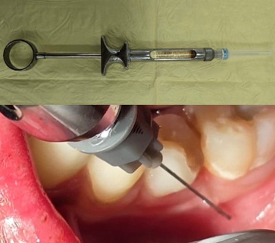 Journal of Clinical Pediatric Dentistry (JOCPD)